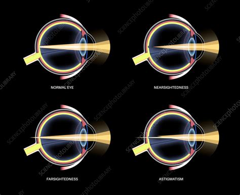 Refractive Errors That Impact Vision Illustration Stock Image F043 8068 Science Photo Library