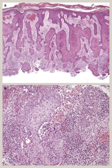 Pyoderma Gangrenosum And Pseudoepitheliomatous Hyperplasia A Poorly