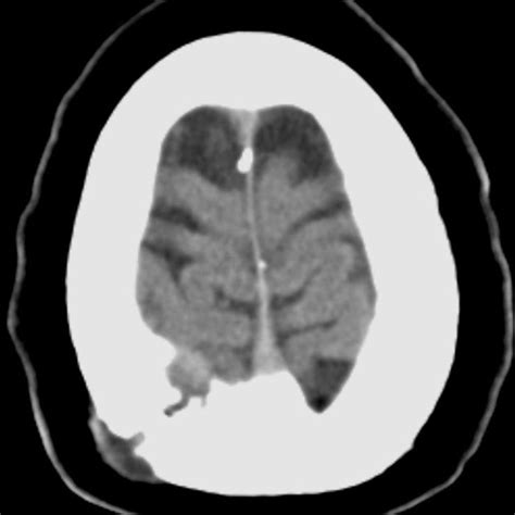 Axial Nonenhanced Ct A Hyperdense Extra Axial Mass In The Right Download Scientific Diagram