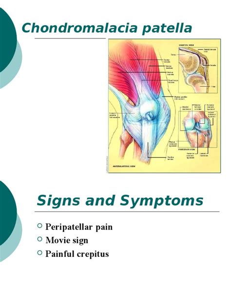 Chondromalacia Patella Signs And Treatment Pdf