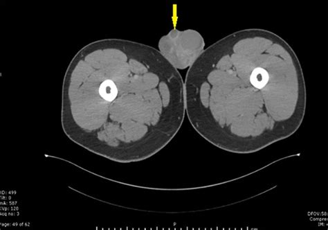 Median Raphe Cyst A Clinically Challenging Diagnosis Pmc