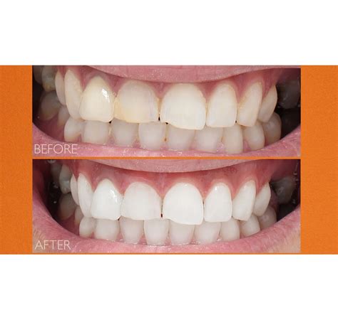 Lab Life Beauty Eclipse Teeth Whitening And Enamel Rejuvenation System Tsc Ca