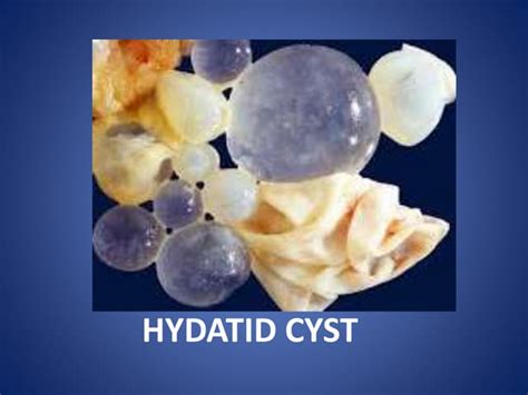 Hydatid Cyst Pptx