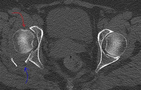 Acetabulum Fractures Acetabulum Lines Radiology Article