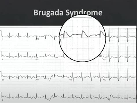 1930 Another Very Classic Example In V1