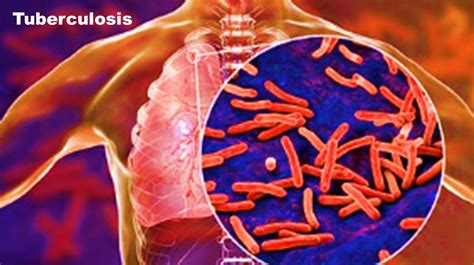 Vistow On Linkedin Who Approves New Tb Test To Help Fight Drug Resistant Strains