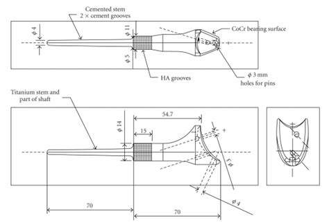 Template Of A Predominantly Titanium Distal Radius Prosthesis With A