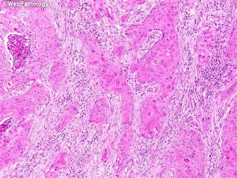 Squamous Cell Carcinoma Of Renal Pelvis
