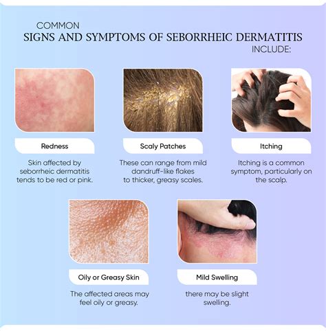 Seborrheic Dermatitis Clinic Rx