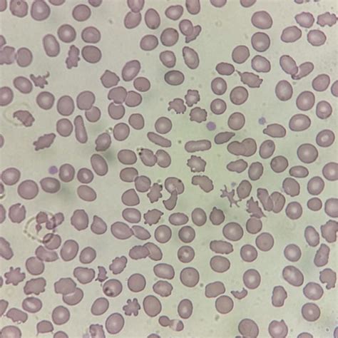 Acanthocytes Spur Cells Mls Hematology Bench And Study Guide