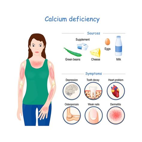 68 Calcium Deficiency Woman Stock Vectors And Vector Art Shutterstock