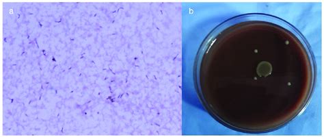 A Microscopic Appearance Of The Smear Of Vitreous Fluid Of Patient