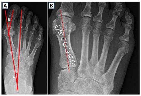 Current Concepts Of Radiographic Evaluation And Surgical Treatment For