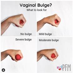 Prolapse Mypfm