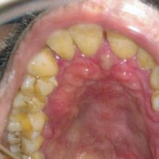 Evidence Of Diffuse Proliferative Soft Tissue Swelling In The Region Download Scientific