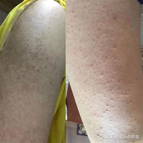 鸡皮肤，毛周角化到底是什么？ 知乎