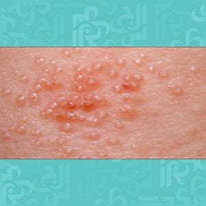 أسباب وأعراض الثآليل التناسلية مجلة الجرس