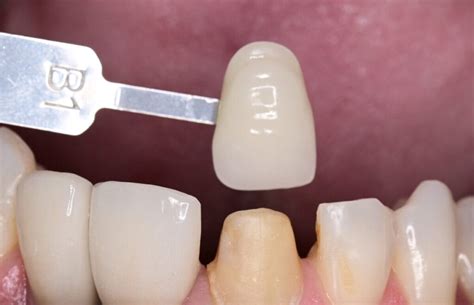Types Of Dental Crowns And How To Choose The Right Material Jdentallog