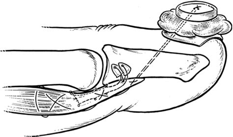 Flexor Tendon Injuries Obgyn Key