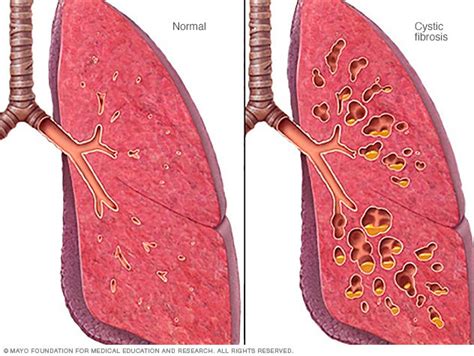 Cystic Fibrosis Lungs Mucus