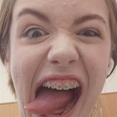 Create Meme Teeth After Removing Braces Braces On Teeth Damon Clear