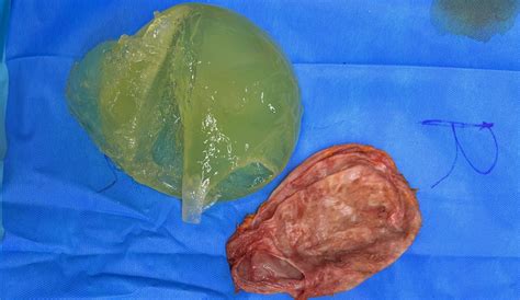 Breast Reconstruction With Diep Flap