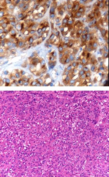 Epithelioid Gastro Intestinal Stromal Tumor Of Stomach Unfavorable