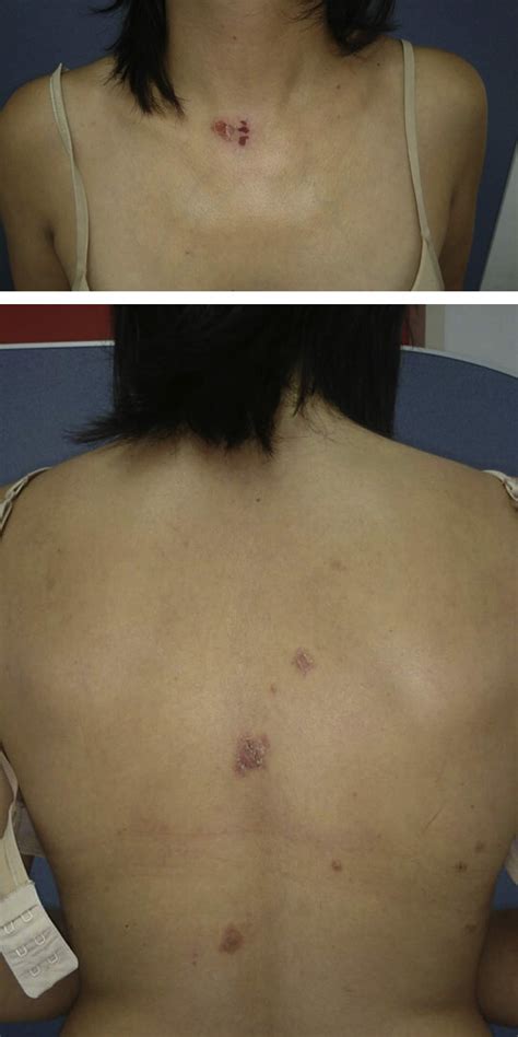 Pemphigus Foliaceus Causes Symptoms Diagnosis Treatment And Prognosis