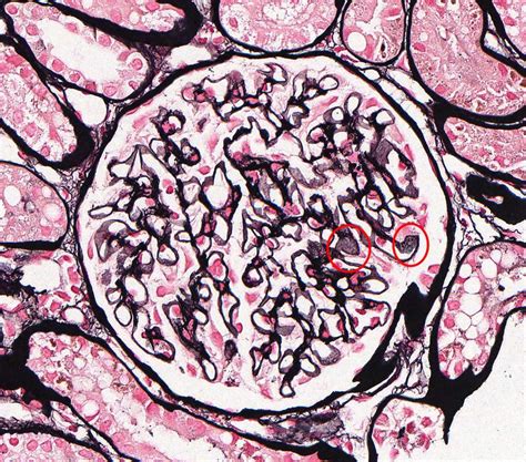 Diffuse Membranous Glomerulonephritis