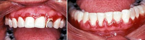 Desquamative Gingivitis Associated With Mucous Membrane Pemphigoid Download Scientific Diagram