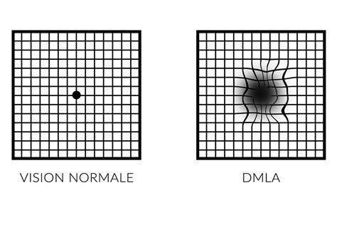 Dmla Dégénérescence Maculaire Liée à Lâge Lusee Fr