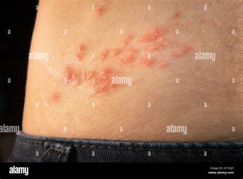 Shingles On Lower Back