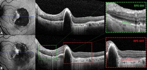Optical Coherence Tomography Features Of The Repair Tissue Following