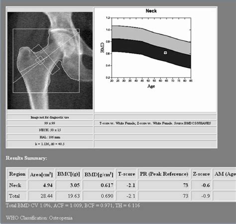 Figure 2 From Bilateral Femoral Neck Bone Mineral Density Analysis In