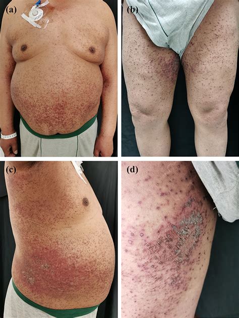 Diffuse Follicular Eruption Induced By Pegylated Liposomal Doxorubicin Ccid