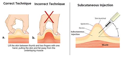 Subcutaneous Injection Technique Zucipharma
