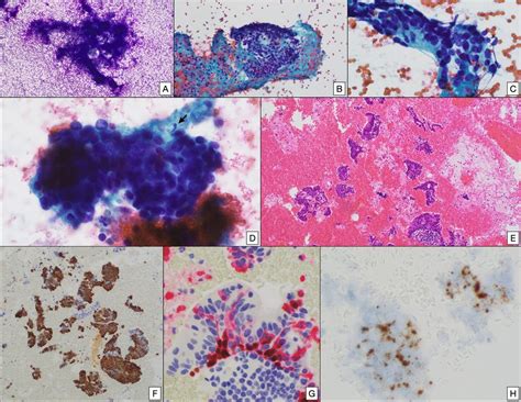 Lymph Node Fna Cytology Findings A Some Groups Of Cells Were Organized Download Scientific