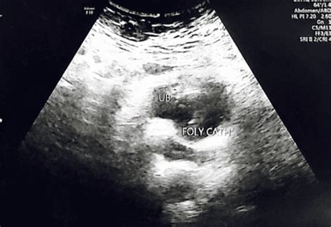 Conservative Management Of Incarcerated Gravid Uterus