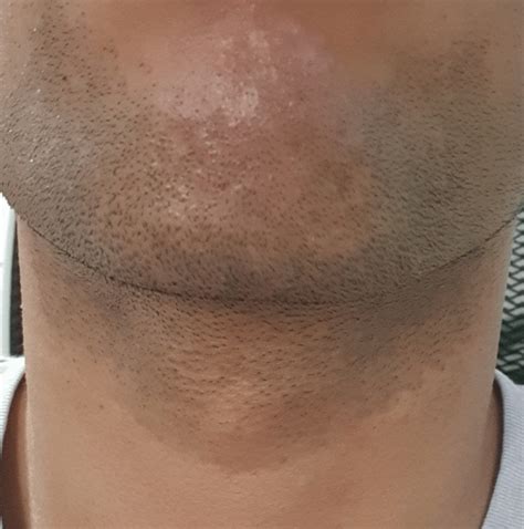How To Avoid Hyperpigmentation On The Neck Area Due To Shaving R
