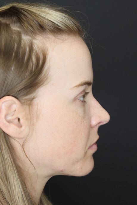 Liquid Rhinoplasty Before And After Photos Raggio Md Facial Plastic
