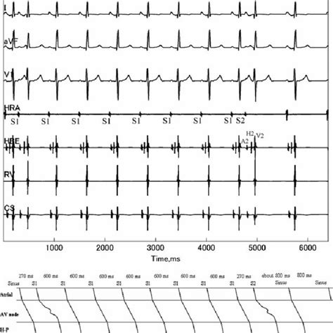 Frontal Cross Section Of The Model Of Heart With Wpw Syndrome Type A