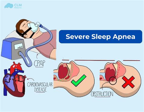 Severe Sleep Apnea Symptoms And Effective Treatment Options