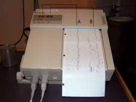 Cardiotocography Pptx