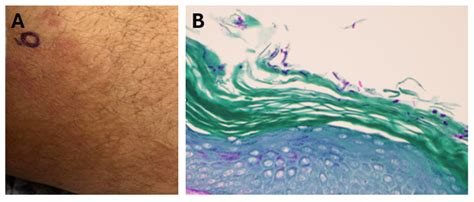 Tinea Cruris Microscope