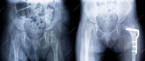 Radiografía Antes Y Después De La Cirugía Osteotomía Femoral Película