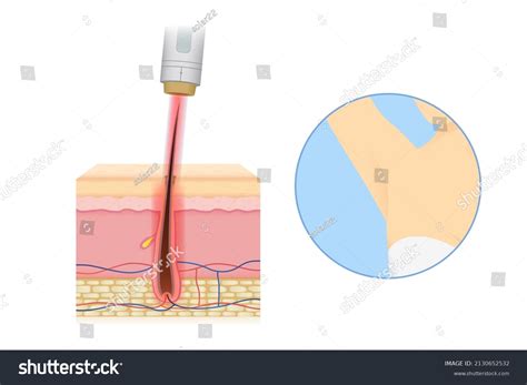 15 Laser Hair Removal Skin Layer Follicle Beauty Smoothness Body Hair