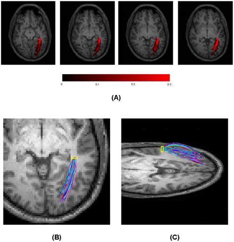 Reconstructed Pathways Of The Left Optic Radiation Of Subject Two Top