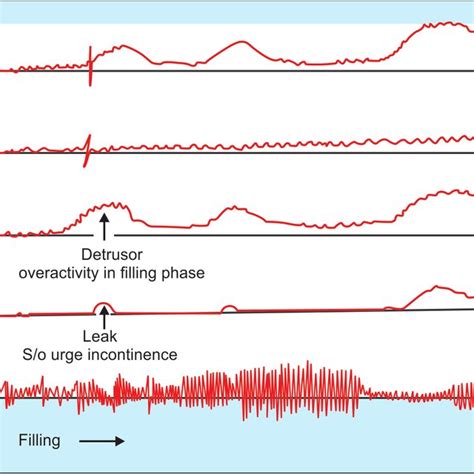 2a To E Common Uroflowmetry Curves A Normal Bell Shaped Curve B