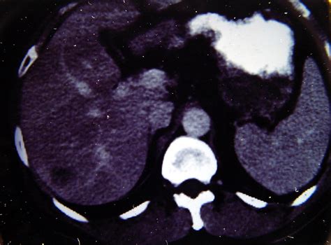 Liver Hematoma 2790 Liver Neoplasm Metastatic Colon Surgery Photos