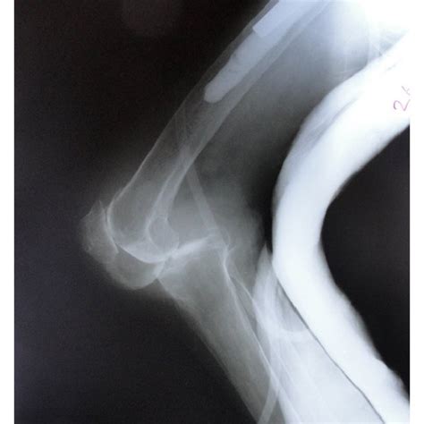 Posterior Knee Dislocation Seen On Radiography Before And After Download Scientific Diagram